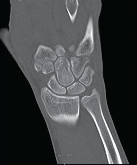 Longitudinal Fracture Epos™