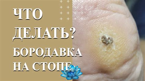 Подошвенная бородавка У клиента бородавка на стопе Как удалить Youtube