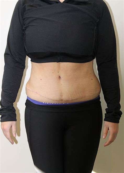 Tummy Tuck Before And After Pictures Norwich Glastonbury Ct