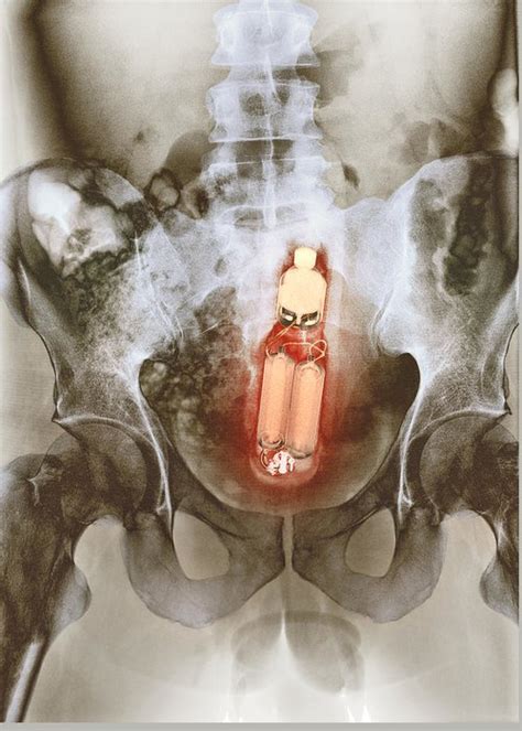 Sex Toy In Mans Rectum X Ray Greeting Card By Du Cane Medical Imaging Ltd