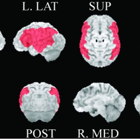 Cortical Surface Map Of The Mca Territory Superimposed On Neurostat T Download Scientific