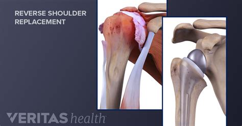 Reverse Shoulder Replacement Surgical Procedure