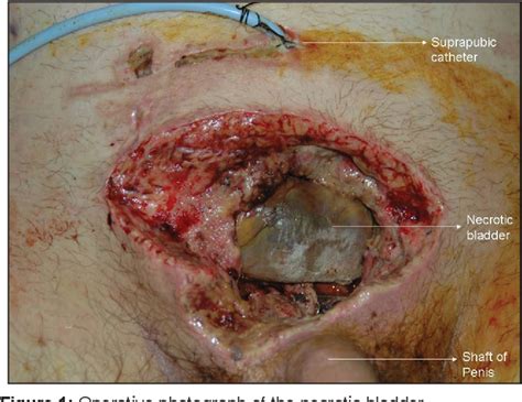 Figure 1 From Bladder Necrosis Secondary To Internal Iliac Artery