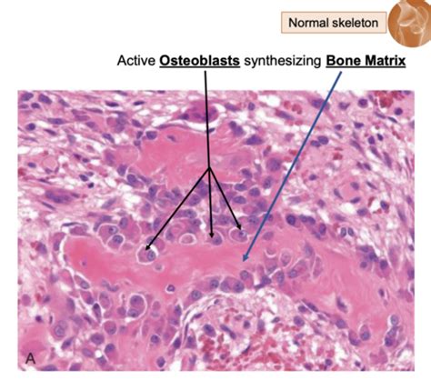 Bone Pathology Flashcards Quizlet