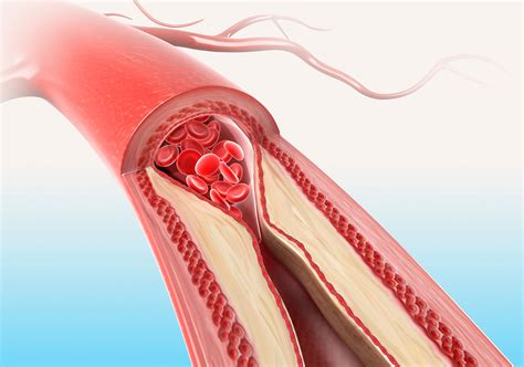 Ateroskleroza Je Skrita Nevarnost Imajo Jo Skoraj Vsi Zdravje