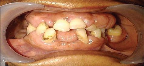 Hereditary Gingival Fibromatosis A Heterogeneous Genetic Di Saudi