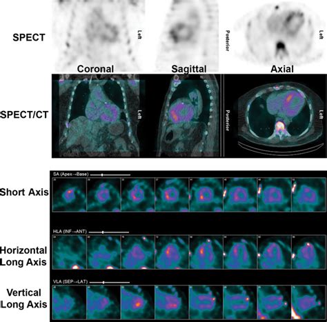 99mtc Bone Avid Tracer Cardiac Scintigraphy Role In Noninvasive