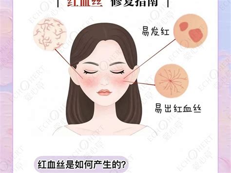 蔻心草护肤小知识：如何快速摆脱红血丝蔻心草 站酷zcool