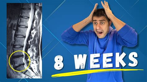 Best Chair For L5 S1 Herniated Disc At Gail Hendershot Blog