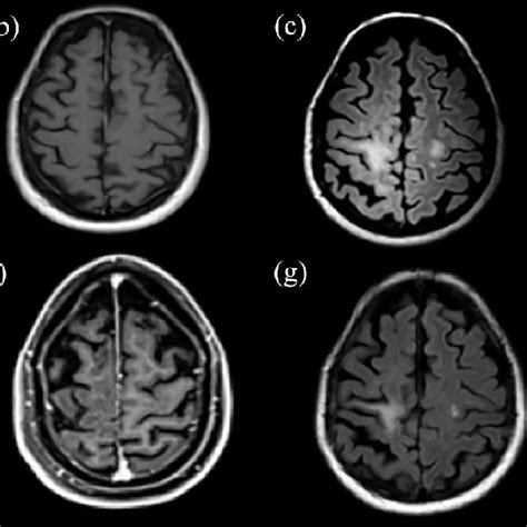 Representative Examples Of Ms Patients Presented With Tumefactive