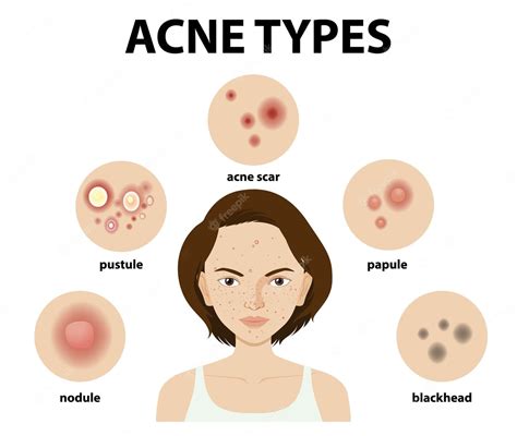 Say Goodbye To Pustules Understanding The Different Types Of Acne Purclarity Skincare