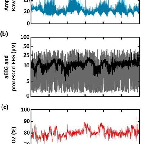 A An Example Of Amplitude Tracing Of 5 H Raw Eeg Recorded With A