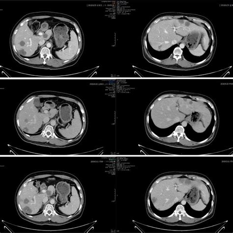 Serial Circulating Tumor Dna Testing For Monitoring Lapatinib