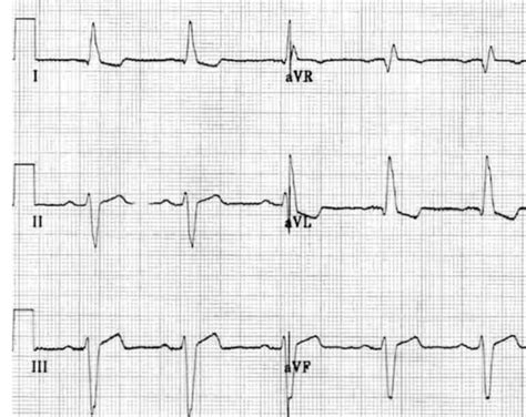 Does This Ecg Have Left Axis Deviation Rstep2