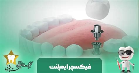 ویژگی‌های فیکسچر ایمپلنت هر آنچه باید بدانید