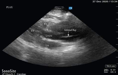 Parasternal Long Axis Displaying The Intimal Flap Within The Aortic Download Scientific Diagram