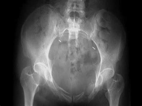 How To Read An Inlet Pelvis Xray Youtube