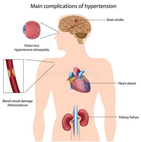 Complications Of Ect