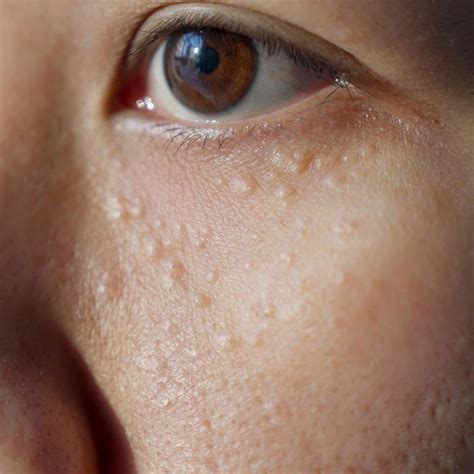 Milia Schedule Your Consultation Today — Fora Dermatology General