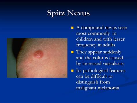 Ppt Skin Tumors Benign And Malignant Powerpoint Presentation Free Download Id3986510