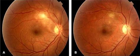 Infectious Causes Of Posterior Uveitis Part 2 Flashcards Quizlet
