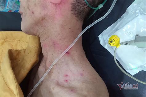 Cứu sống hai cha con bị ong đốt hàng trăm nốt VietNamNet