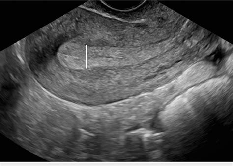 Thickened Endometrium Due To Hormonal Imbalance At Abbey Takasuka Blog