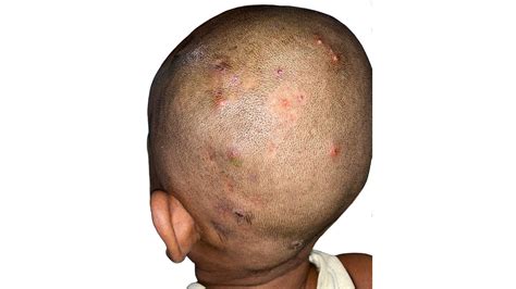 Folliculitis Scalp