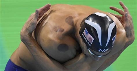 [사진] 펠프스 어깨에 선명한 부항 자국