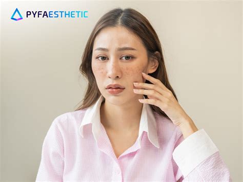 Pentingnya Sunscreen Untuk Mencegah Melasma Berulang