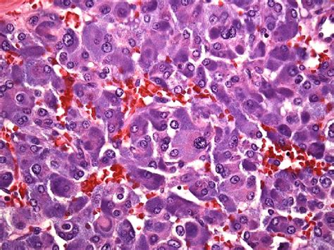 Photomicrograph Pheochromocytoma Demonstrating Sheets Of Large
