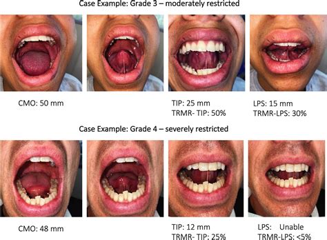 Assessment Of Posterior Tongue Mobility Using 47 Off