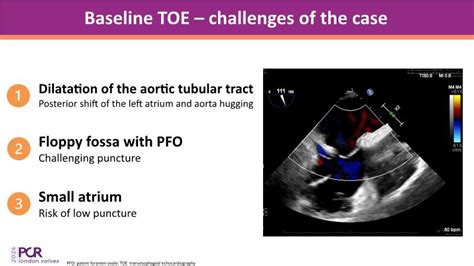 Transforming Interventional Care For Patients With Mitral Regurgitation Simulation And Case