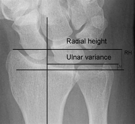 Ulnar Variance Definition Types Measurement Clinical Relevance