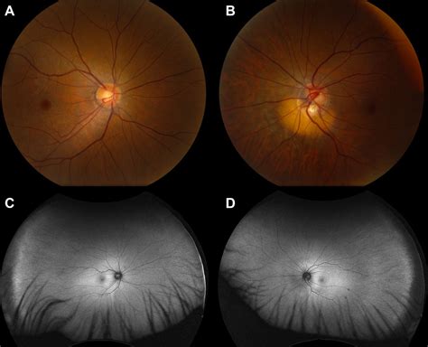 Peripapillary Atrophy