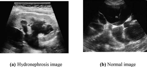 Ultrasound Image Assisted Diagnosis Of Hydronephrosis Based On Cnn
