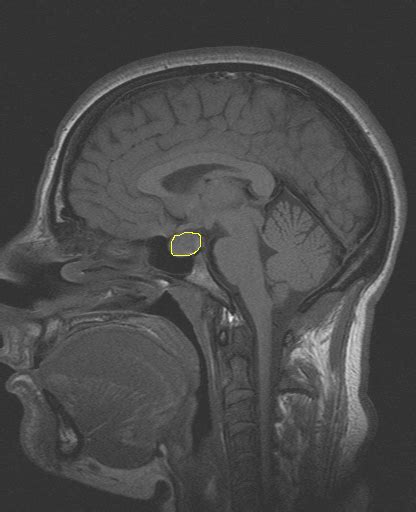 14 Initialization Contour And Automatic Segmentation Result For Download Scientific Diagram
