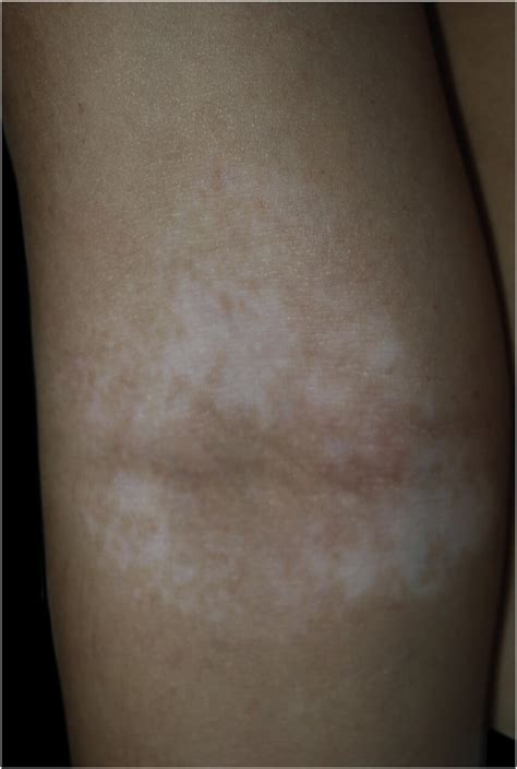Small Hypopigmented Macules Of The Antecubital Fossacase 1 Download Scientific Diagram