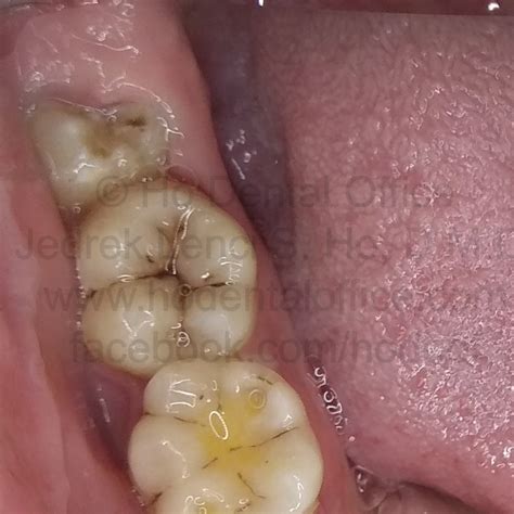 Operculectomy Dental Circumcision Ho Dental Office Dentist