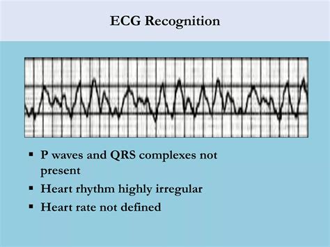 Lec 9 Narrow Complex Wide Complex Tachycardia For Mohs Pptx Heart And Cardiovascular