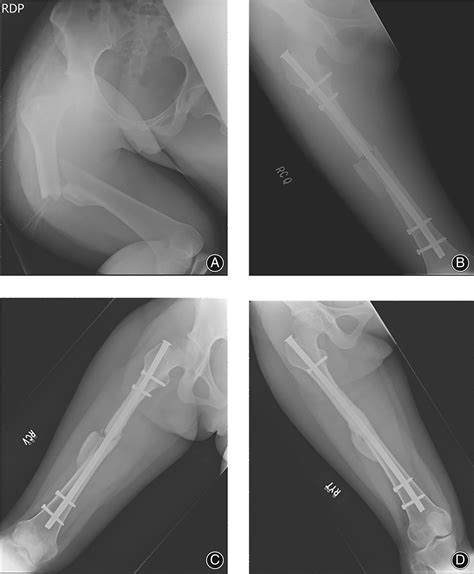 Butterfly Fracture Of Tibia Types Of Fractures Outcome Of 35 Mm