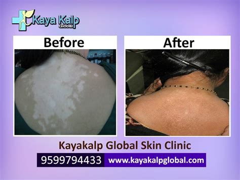 Best Vitiligo Treatment In Delhi Find The Best Vitiligo Treatment In By Kaya Kalp Global