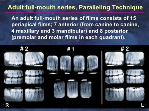 Radiology Paralleling Technique