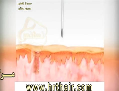 کلیپ انیمیشن کاشت مو و پیوند مو به روش Sut