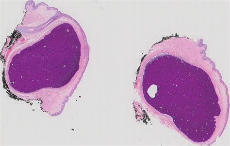 Multiple Nodules On The Scrotum MDedge Dermatology