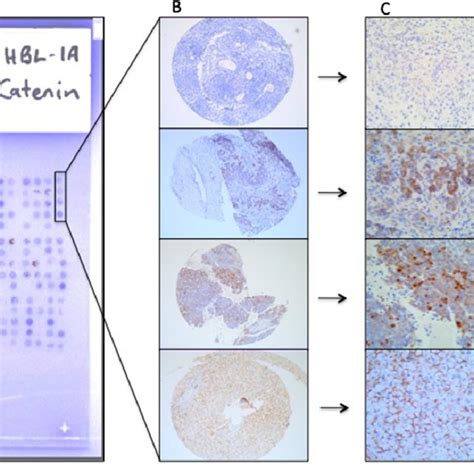 Example Of A Tissue Microarray Section Used In This Study A It