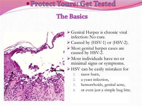Hsv1 And Hsv2 Genital Herpes