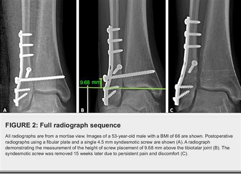 Figure 2 From Comparison Of Risk Factors Between Syndesmotic Screws