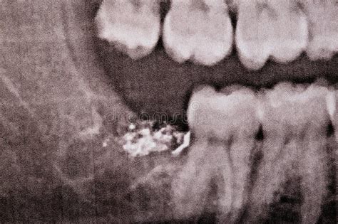 Empty Tooth Socket With Medicine After Wisdom Tooth Removal On X Ray