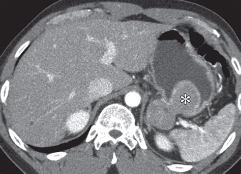 Beyond The Gist Mesenchymal Tumors Of The Stomach Radiographics